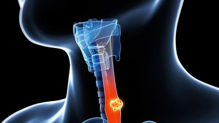 Le traitement du cancer de